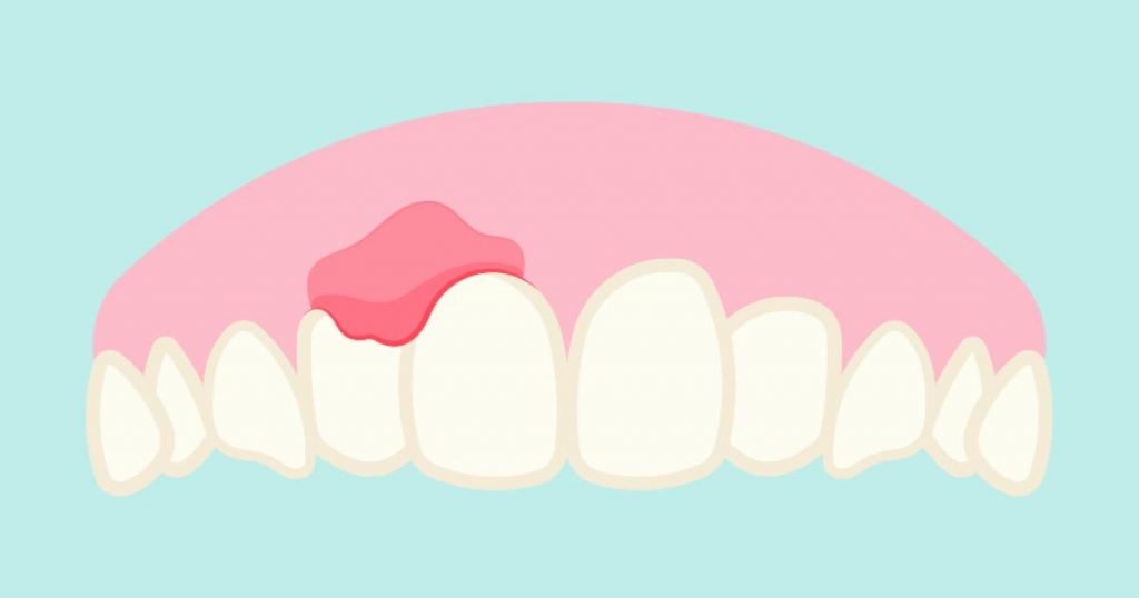 Absceso dental: ¿Qué es y cuál es su tratamiento?