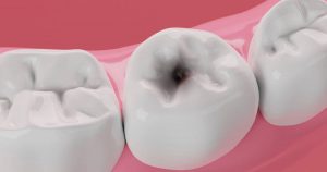 ¿Muelas picadas? Conoce qué hacer y cómo quitar el dolor