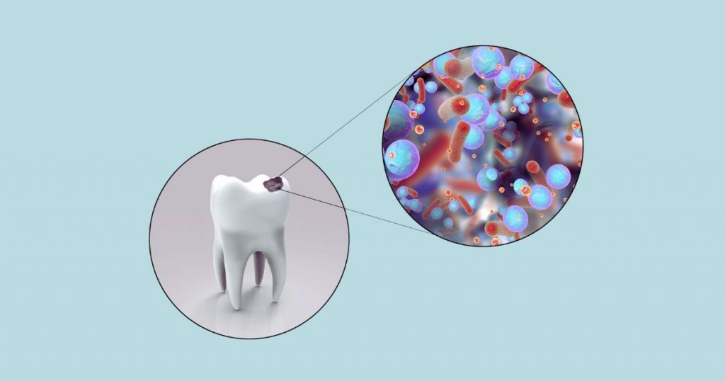 Caries Dental Pequeña: cómo detectarla y saber si tengo