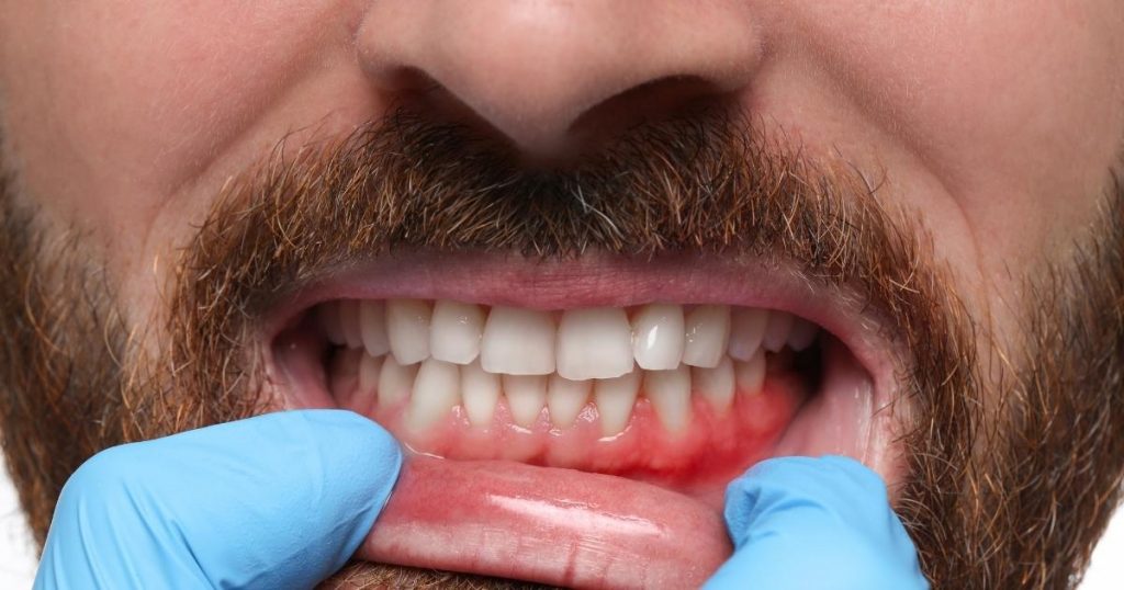 Dientes flojos: causas más comunes, periodontitis y cómo tratarlo