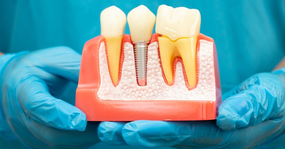 Necrosis Pulpar: Qué es, Síntomas y ¿Tiene Solución? - Clínica Dental ...